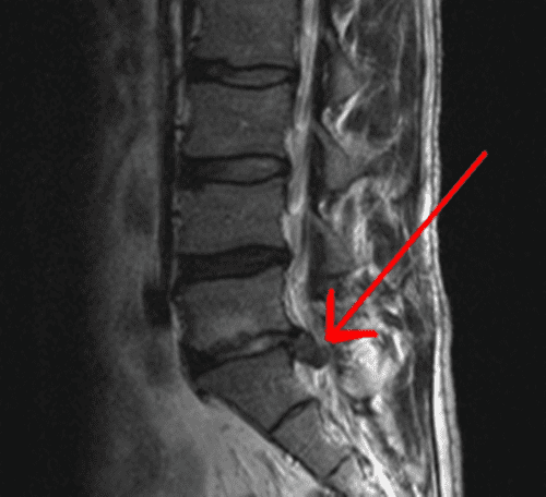 Mri Evidence Of Disc Herniation Is Not Predictive Of Clinical Outcome