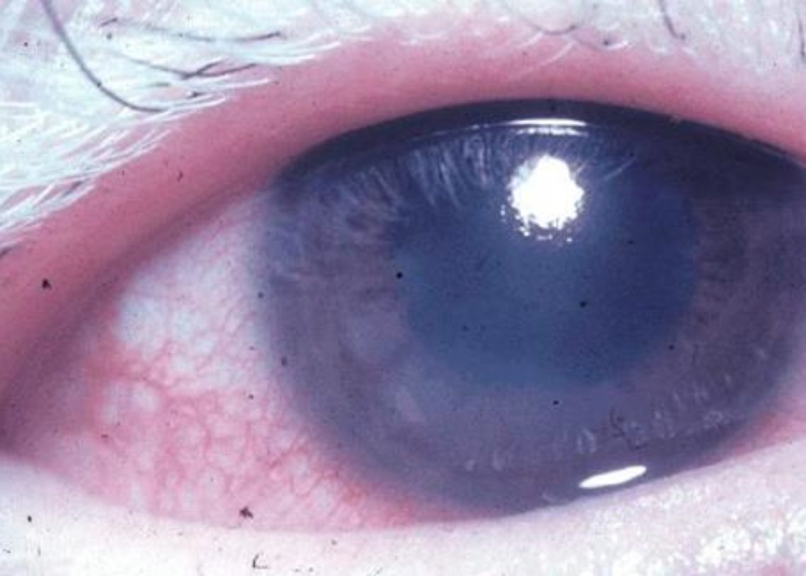 Patient Basics: Uveitis | 2 Minute Medicine