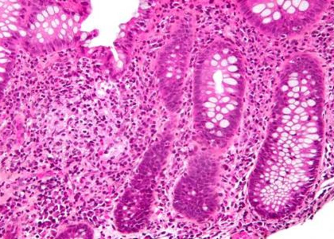 Quick Take: Trends in diverting loop ileostomy vs. total abdominal ...