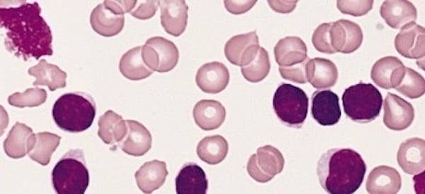 Venetoclax (Venclyxto) expands treatment options as chronic lymphocytic ...