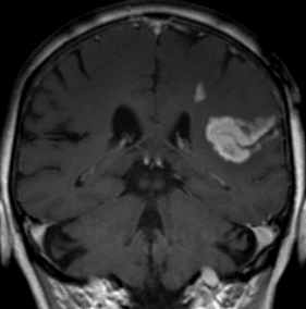 Thrombectomy may improve functional independence in acute ischemic ...