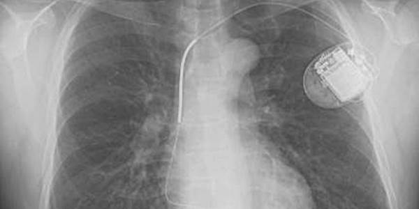 Prophylactic implantable cardioverter-defibrillators may decrease ...