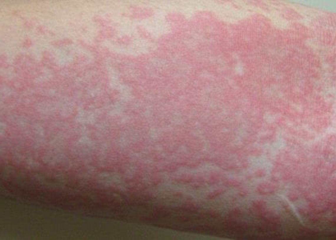 Patient Basics: Hives (Urticaria) | 2 Minute Medicine