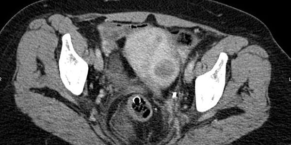 Contained morcellation for benign gynecologic surgeries feasible ...