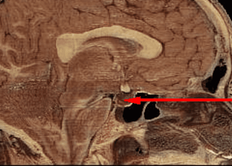 CT may be superior to MRI for pituitary tumor detection | 2 Minute Medicine