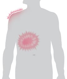 Patient Basics: Biliary Colic | 2 Minute Medicine