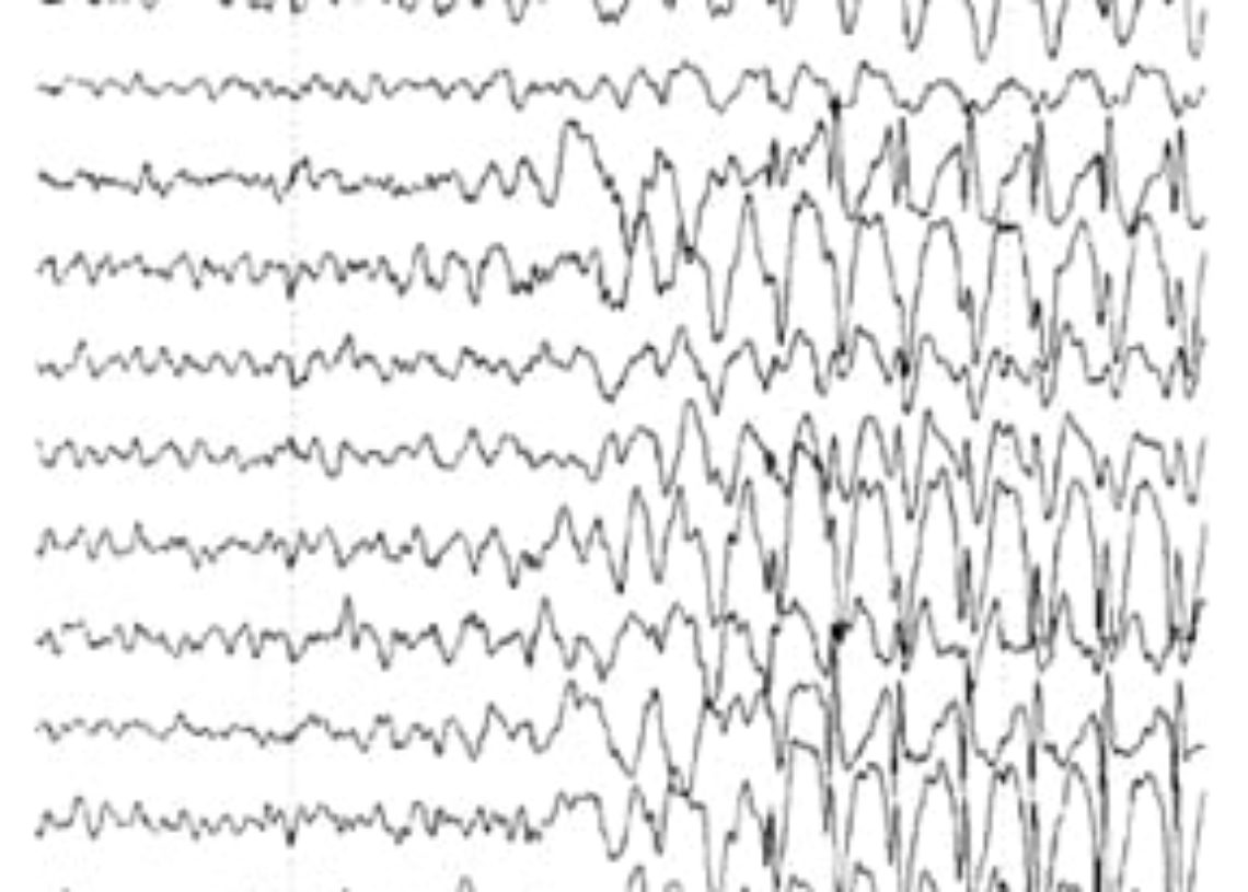 Patient Basics: Coma and Persistent Vegetative State | 2 Minute Medicine