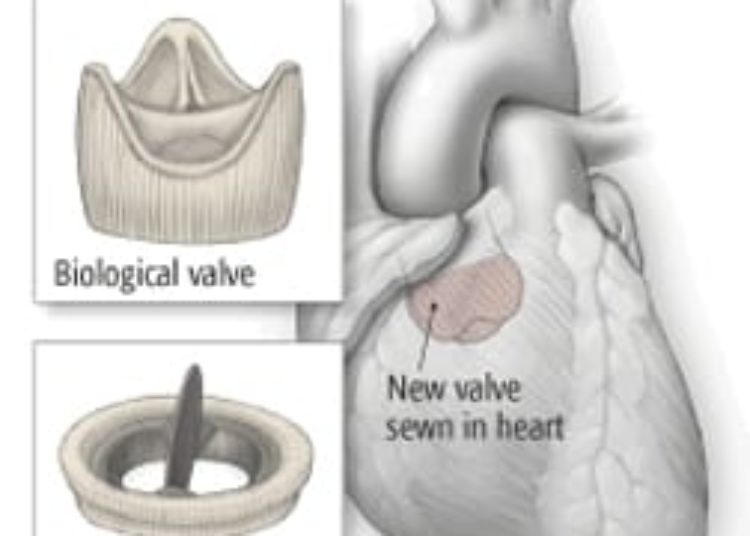 #VisualAbstract: Transcatheter aortic valve implantation is associated with reduced rate of ...
