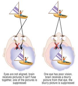 Patient Basics: Lazy Eye (Amblyopia) | 2 Minute Medicine