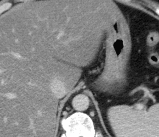 NASH | 2 Minute Medicine