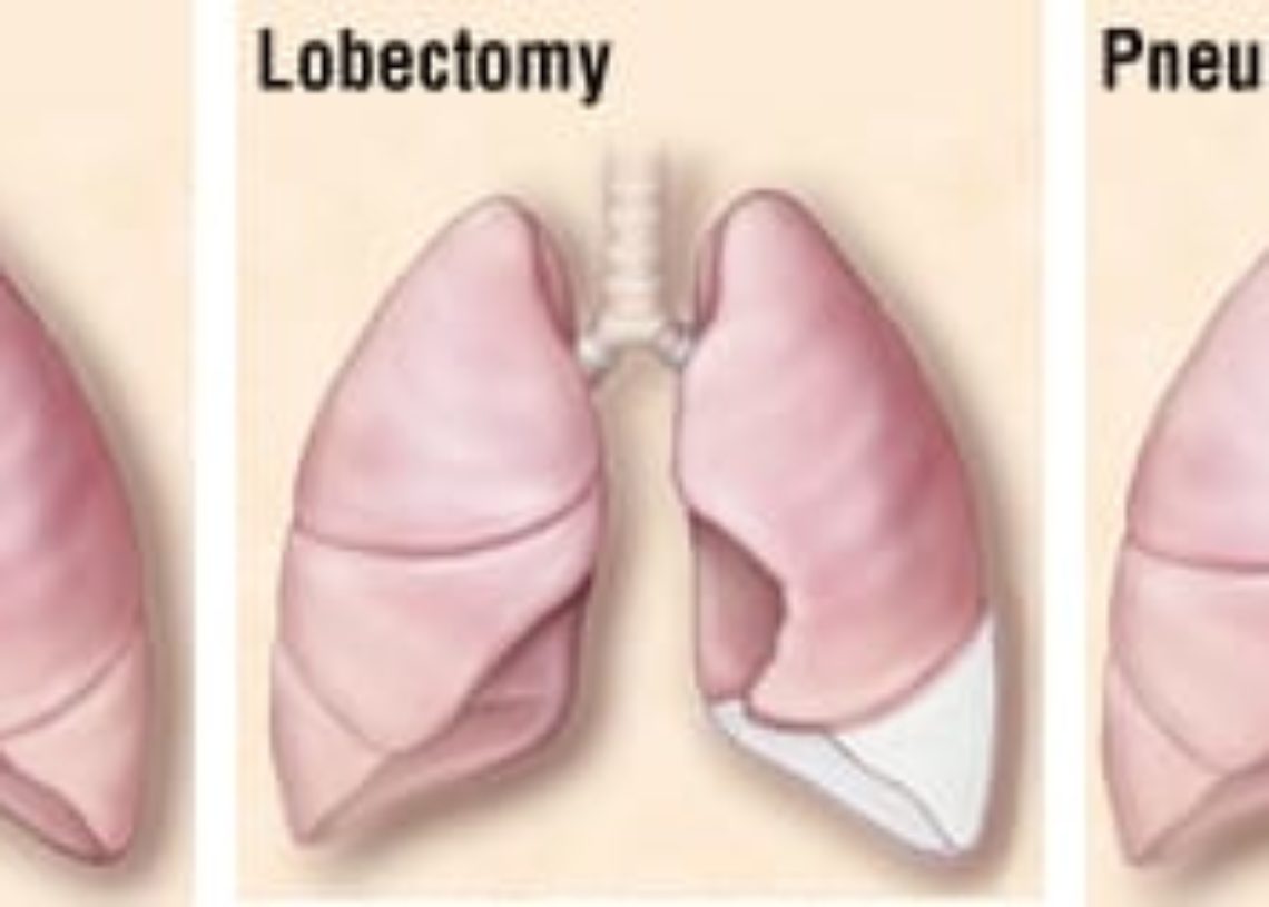 LUNG-RADS criteria increases positive predictive value for lung cancer ...