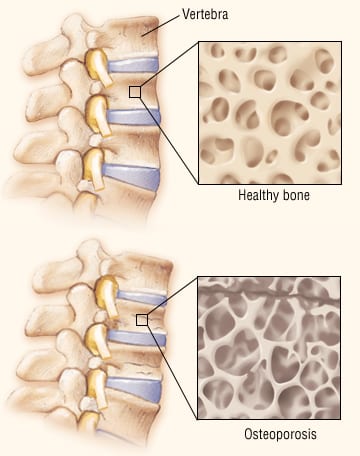 Patient Basics: Osteoporosis | 2 Minute Medicine