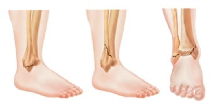 Patient Basics: Ankle Fracture | 2 Minute Medicine