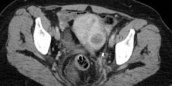 Relugolix Combination Therapy Led To Reduction In Uterine Fibroid Symptoms 2 Minute Medicine