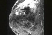 The Wells DVT criteria: Clinical prediction model for deep vein ...