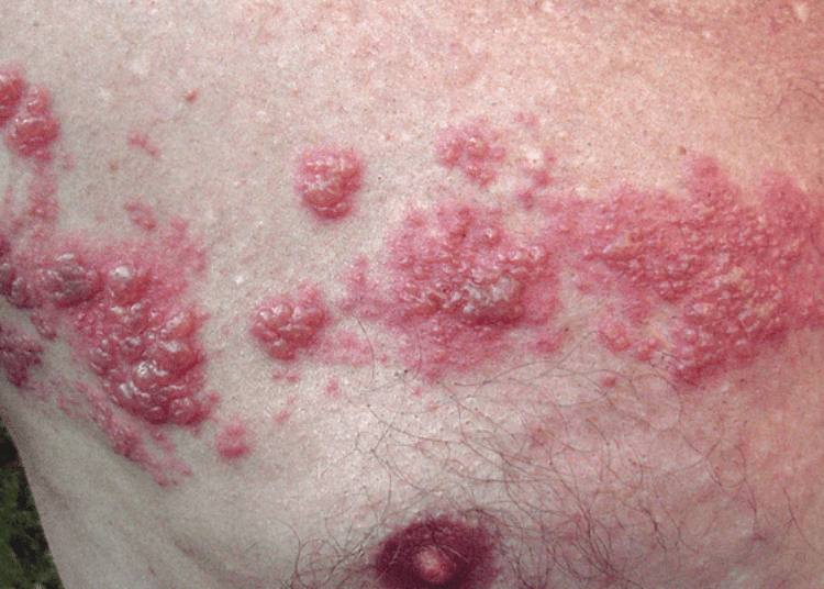 Patient Basics: Shingles (Herpes Zoster) | 2 Minute Medicine