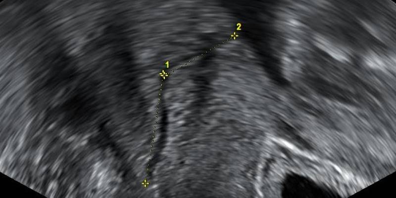 Cervical length at term helps predict delivery date | 2 Minute Medicine