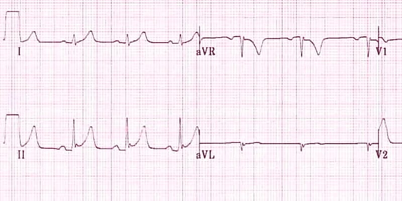 Early repolarization on ECG not associated with long-term prognosis | 2 ...