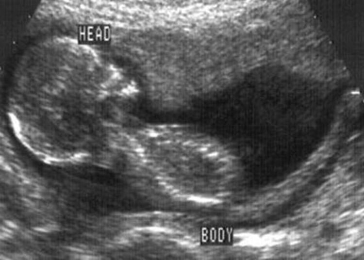 Point-of-care ultrasound effectively identifies pediatric skull ...