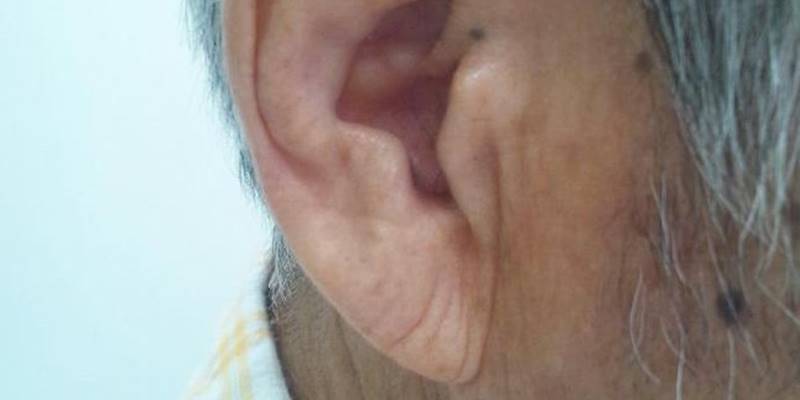 Bilateral diagonal earlobe creases associated with increased risk of ... Bilateral diagonal earlobe creases associated with increased risk of ...