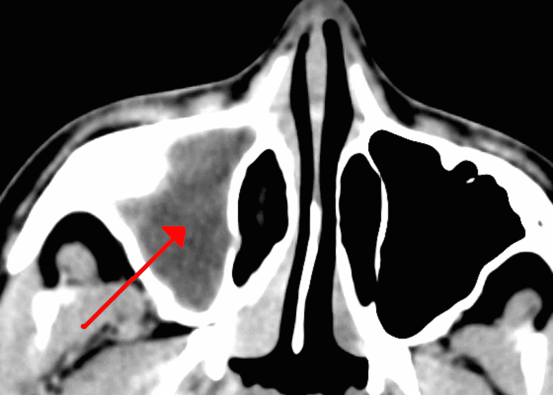 Patient Basics: Chronic Sinusitis (in Adults) | 2 Minute Medicine