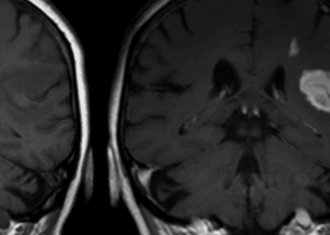 The EXTEND trial: neurological deficits decreased with thrombolysis up ...
