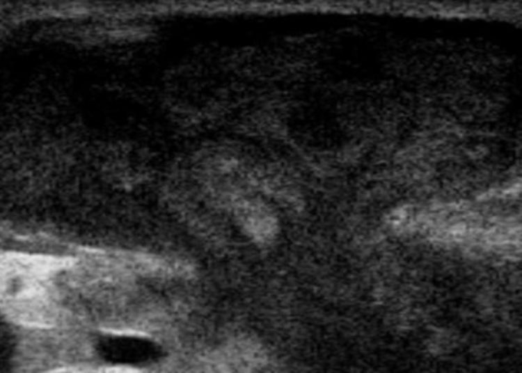 Compression ultrasound identifies proximal deep venous thrombosis with ...