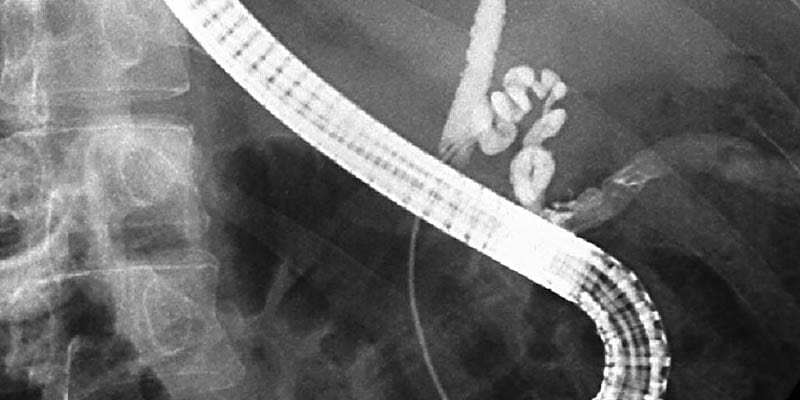 Annular Pancreas Ercp