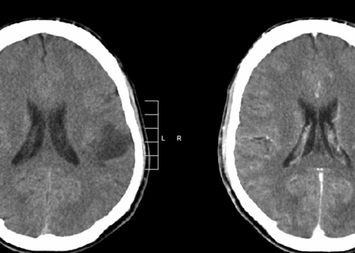 Vorasidenib in IDH1- or IDH2-Mutant Low-Grade Glioma | 2 Minute Medicine