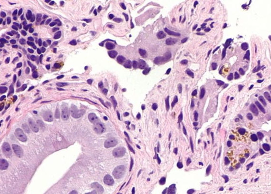 Quick Take: Association of Disease Recurrence With Survival Outcomes in ...