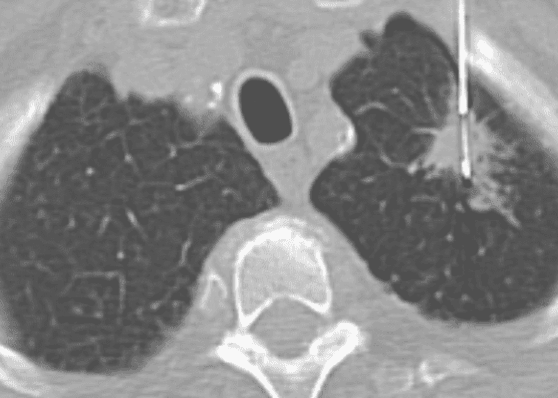 LUNG-RADS criteria increases positive predictive value for lung cancer ...