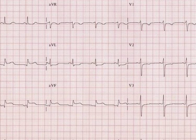 #VisualAbstract: Complete Revascularization with Multivessel PCI for ...
