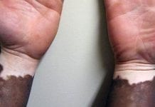 Vitiligo associated with lower incidence of skin cancers | 2 Minute ...