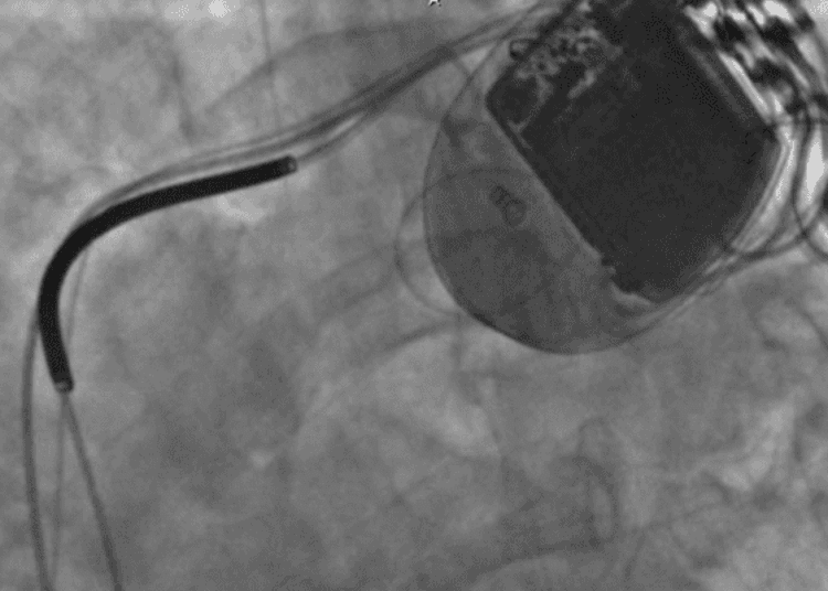 The MADIT-CRT trial: Cardiac resynchronization therapy in heart failure ...