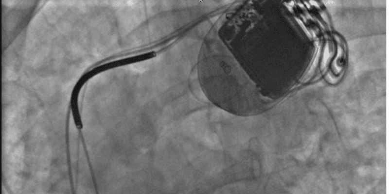 Safety of MRI for patients with legacy cardiac devices | 2 Minute Medicine