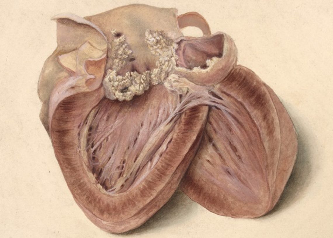 FDG-PET scanning demonstrates prognostic significance in prosthetic ...