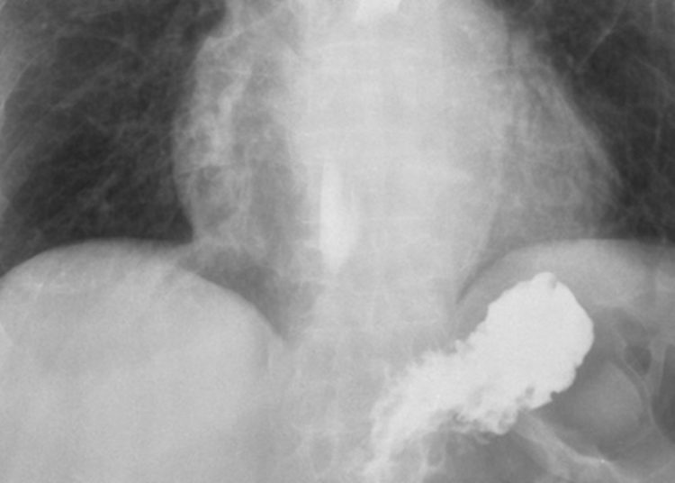 High recurrence of gastroesophageal reflux disease in patients treated ...