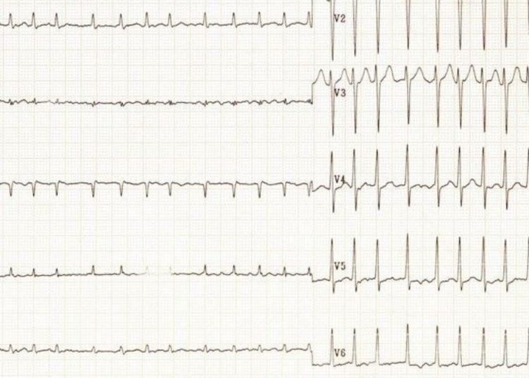 The AFFIRM trial: Rate-control vs. rhythm-control in atrial ...