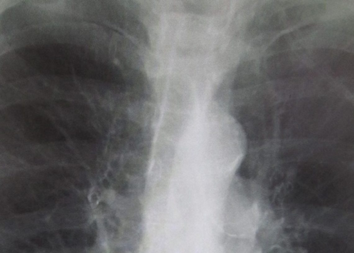 GSK: Depemokimab Monoclonal Antibody Reduces Asthma Attacks | 2 Minute ...