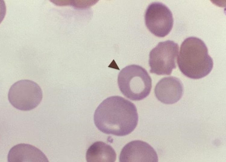 Data supports limiting blood transfusions for moderate anemia | 2 ...