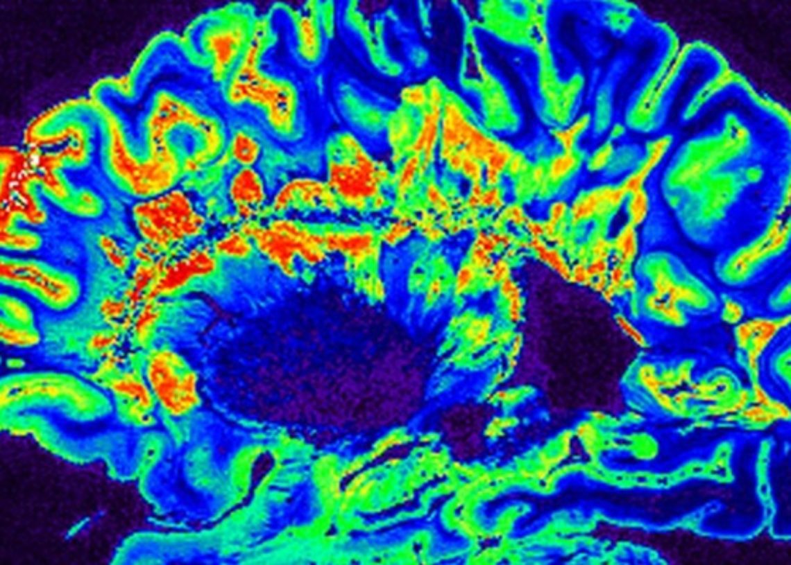 #VisualAbstract: Association of Initial Disease-Modifying Therapy With Later Conversion to ...