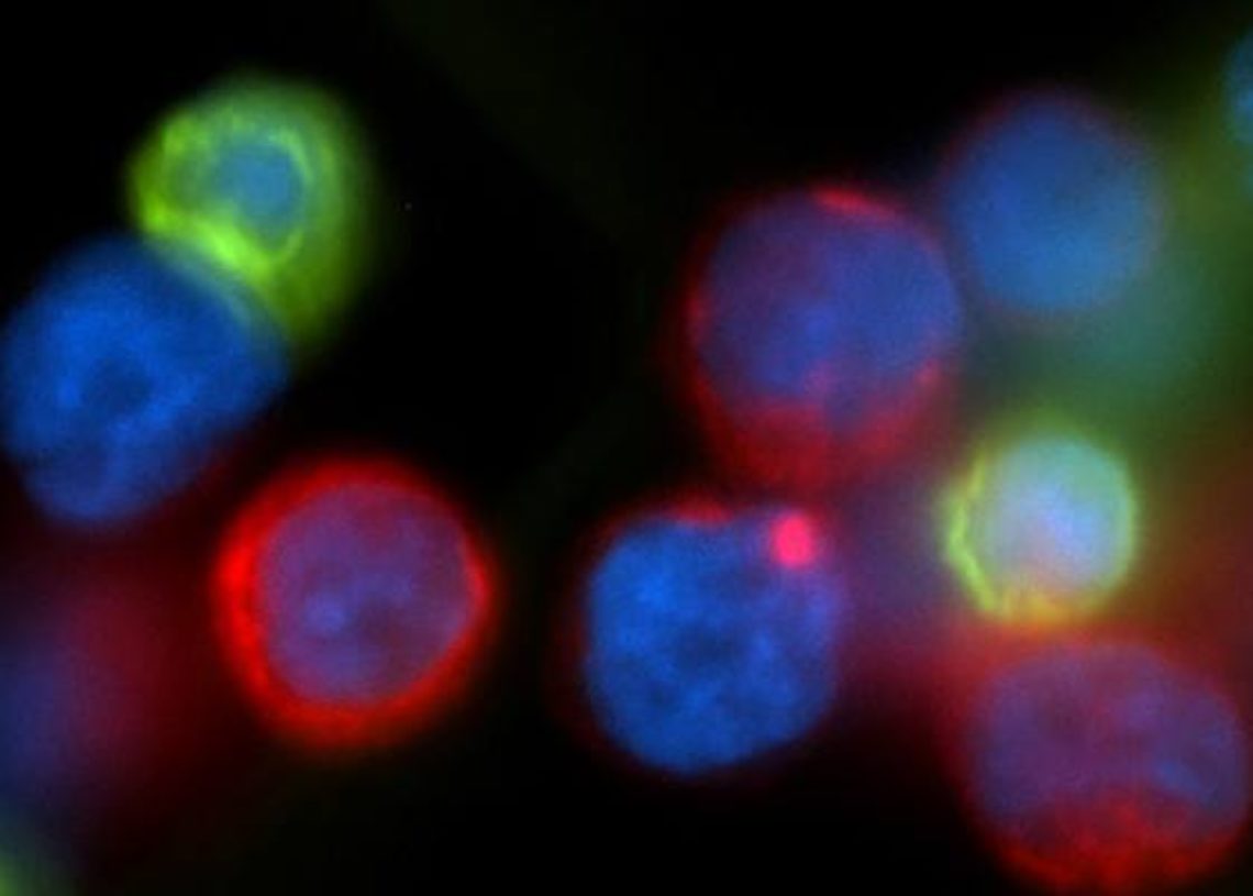 LUNG-RADS criteria increases positive predictive value for lung cancer ...