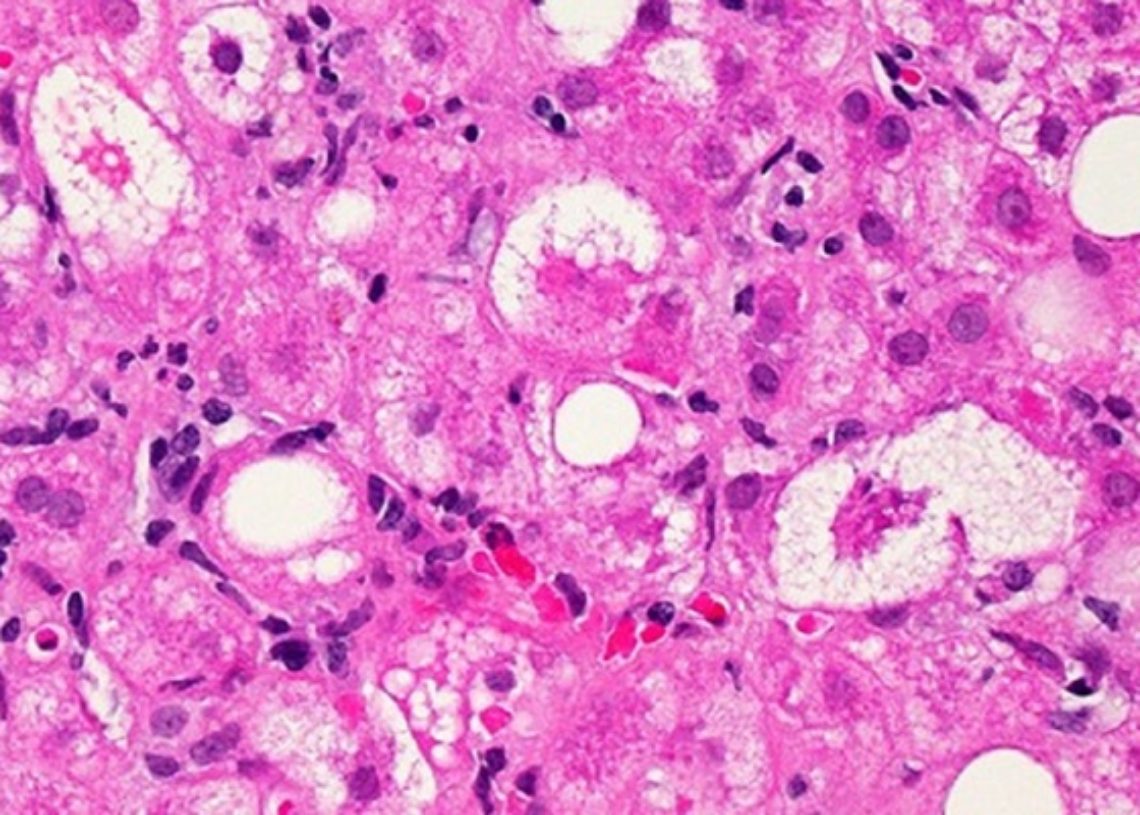 Quick Take: Pegbelfermin (BMS-986036), a PEGylated Fibroblast Growth ...