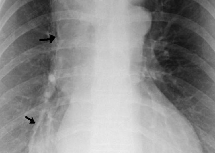 Patient Basics: Achalasia | 2 Minute Medicine