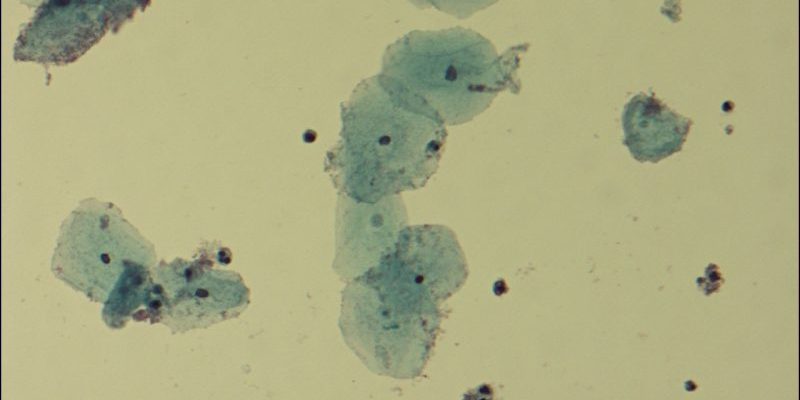 Biotherapeutic Lactin-V reduces incidence of bacterial vaginosis ...