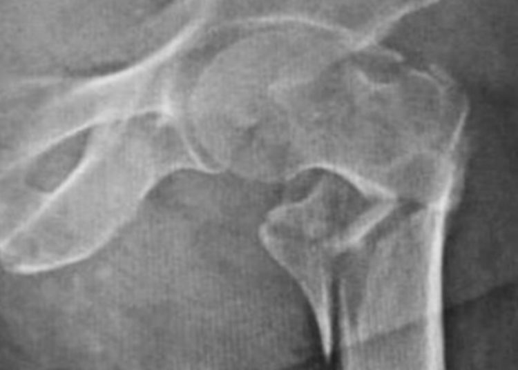 Total hip arthroplasty versus hemiarthroplasty for management of hip ...